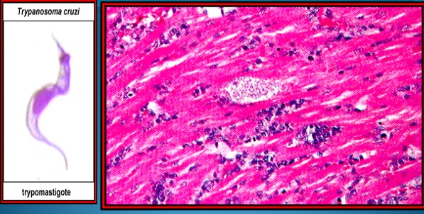 Enfermedad de Chagas, contribuciones a su estudio y abordaje